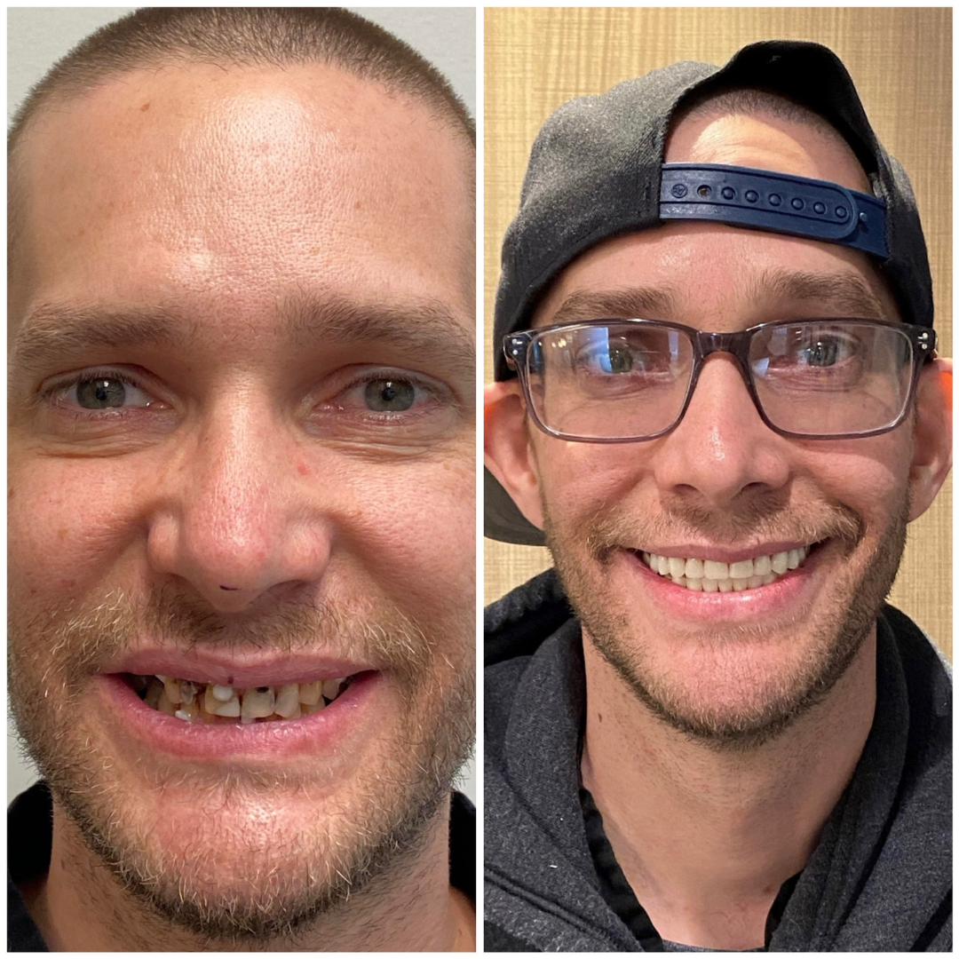 Full Mouth Restoration Overland Park | OP Implant Dental